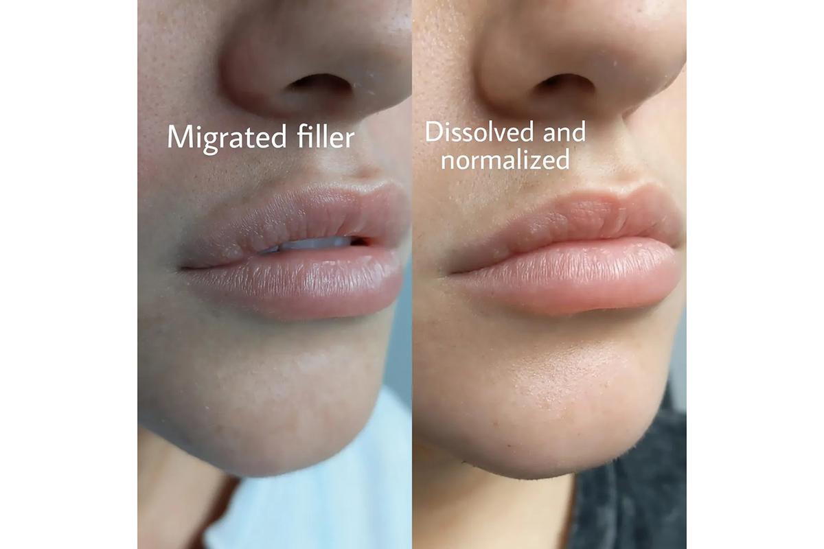 What Is Filler Migration And What To Do About It